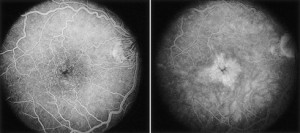 Cystoid Macular Edema - Retina Consultants