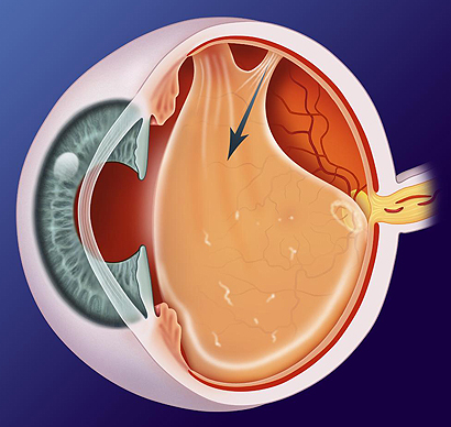 Posterior Vitreous Detachment (Floaters and Flashes) - Retina Consultants